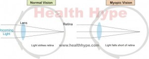 Myopic Vision (Short Sighted) and Myopia in Adults and Children ...
