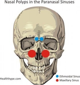 What is a Nasal Polyp - Growth in the Nose Cavity, Sinus - Healthhype
