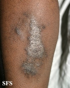 Neurodermatitis (Lichen Simplex Chronicus) Chronic Scratch Rash ...