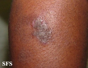 Neurodermatitis (Lichen Simplex Chronicus) Chronic Scratch Rash ...