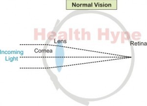 Distorted Vision - Types and Causes - Healthhype