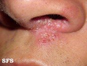 Sore in Nose (Boils, Pimples, Scabs) Causes and Treatments - Healthhype