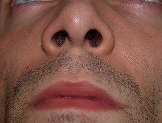 Nasal Pain - Causes of Pain On or Inside the Nose - Healthhype