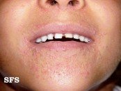 Rash Around Mouth (Lips) Causes, Pictures, Treatment - Healthhype