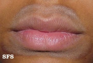 Perioral Dermatitis (Skin Rash around the Mouth) - Healthhype