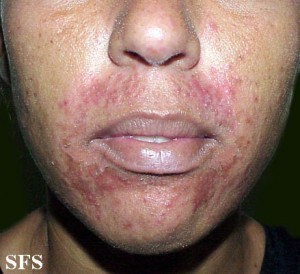 Perioral Dermatitis (Skin Rash around the Mouth) - Healthhype