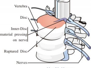 Pinched Nerve Lower Back - Lumbar Nerve Compression - Healthhype
