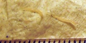 Pinworm Infection Pictures, Symptoms, Testing, Treatment - Healthhype