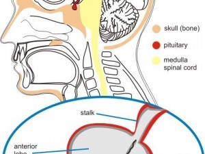 Overactive Pituitary Gland (Hyperpituitarism), Pituitary Adenomas ...