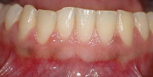 Gingivitis Types, Symptoms, Causes, Treatment, Prevention - Healthhype
