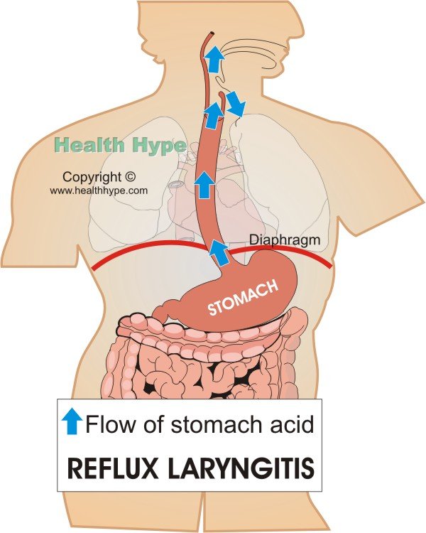 Reflux Laryngitis Voice Box Larynx Acid Irritation Healthhype Reflux Laryngitis Voice Box Larynx Acid Irritation Healthhype