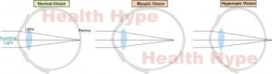 Blurry Vision and Cloudy or Hazy Vision - Healthhype