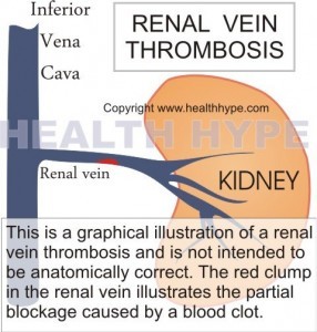 Renal Vein Thrombosis (Blood Clot in Kidney Vein) | Healthhype.com