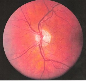 Eye Stroke (Retinal Artery Occlusion) - Healthhype