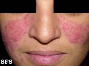 Rosacea (Red Skin Rash) Causes, Phases, Pictures, Treatment - Healthhype