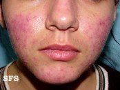 Rosacea (Red Skin Rash) Causes, Phases, Pictures, Treatment - Healthhype