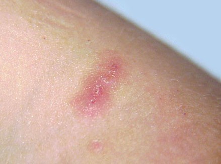 Itch Caused by Dust and Skin Mites: Scabies, Chiggers, Demodex Mites ...