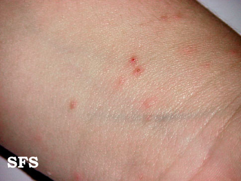 Scabies Skin Infestation (Children, Adults) Pictures, Treatment ...