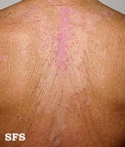 Seborrheic Dermatitis Pictures, Treatment (Face, Scalp, Newborns ...