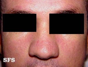 Seborrheic Dermatitis Pictures, Treatment (Face, Scalp, Newborns ...