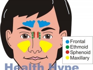 Sinus Pain (Painful Sinusitis) - Location, Causes and Treatment ...