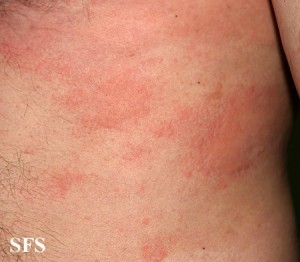 Solar Urticaria (Sun-Induced Hives) | Healthhype.com