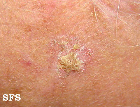 Skin Sun Damage - Symptoms and Pictures - Healthhype