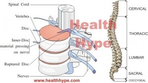 Spinal Stenosis and Surgery for Narrow Spine Canal - Healthhype