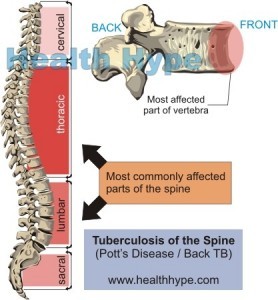 Bone Tuberculosis and Back TB (Pott's Disease) - Healthhype