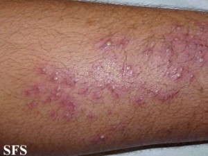 Vancomycin Resistant Staphylococcus Aureus ~ VRSA (and VISA) - Healthhype