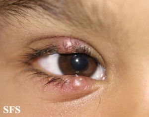 Stye (Hordeolum) Causes, Pictures, Treatment, Remedies - Healthhype