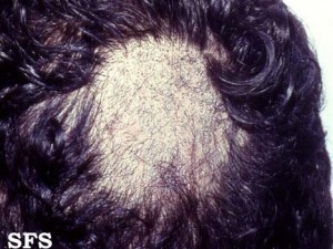 Tinea Faciei (Fungal Skin Infection of the Face) - Healthhype