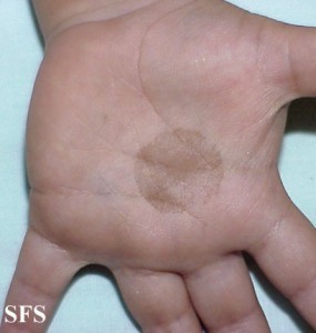 Itchy Palms (Inside of Hand) Causes and Pictures - Healthhype