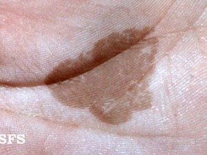 tinea Archives - Healthhype