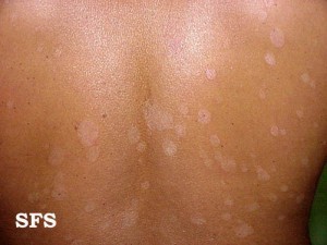 Itchy Back Rash Pictures, Skin Problems and Other Causes - Healthhype