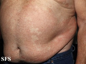 tinea Archives - Healthhype