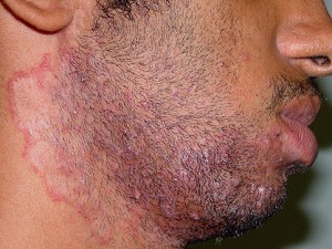 Armpit Fungus Infection, Irritation and Allergies | Healthhype.com