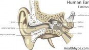 Tinnitus - Causes, Symptoms of Ringing Sound in the Ears - Healthhype