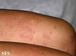 Urticaria (Hives, Itchy Red Skin Welts) and Angioedema (Swelling ...