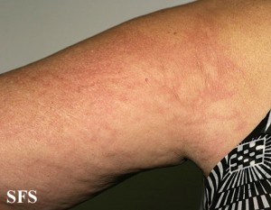 Urticaria (Hives, Itchy Red Skin Welts) and Angioedema (Swelling ...