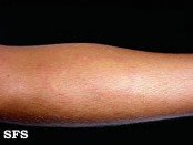 Urticaria (Hives, Itchy Red Skin Welts) and Angioedema (Swelling ...