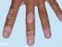 Vitiligo (White Patchy Skin Disease) Causes, Symptoms, Pictures ...