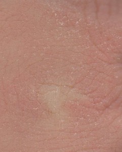 Hand Dermatitis (Eczema of the Hands) - Healthhype